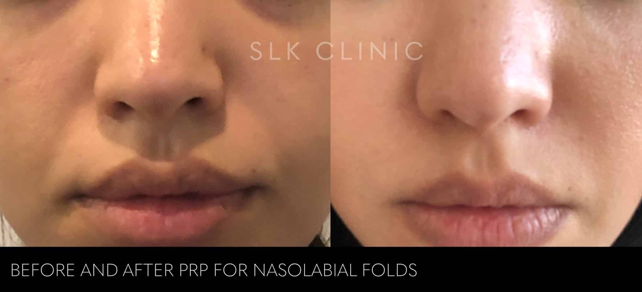 Platelet-Rich Plasma Therapy for Skin & Hair | SLK Clinic