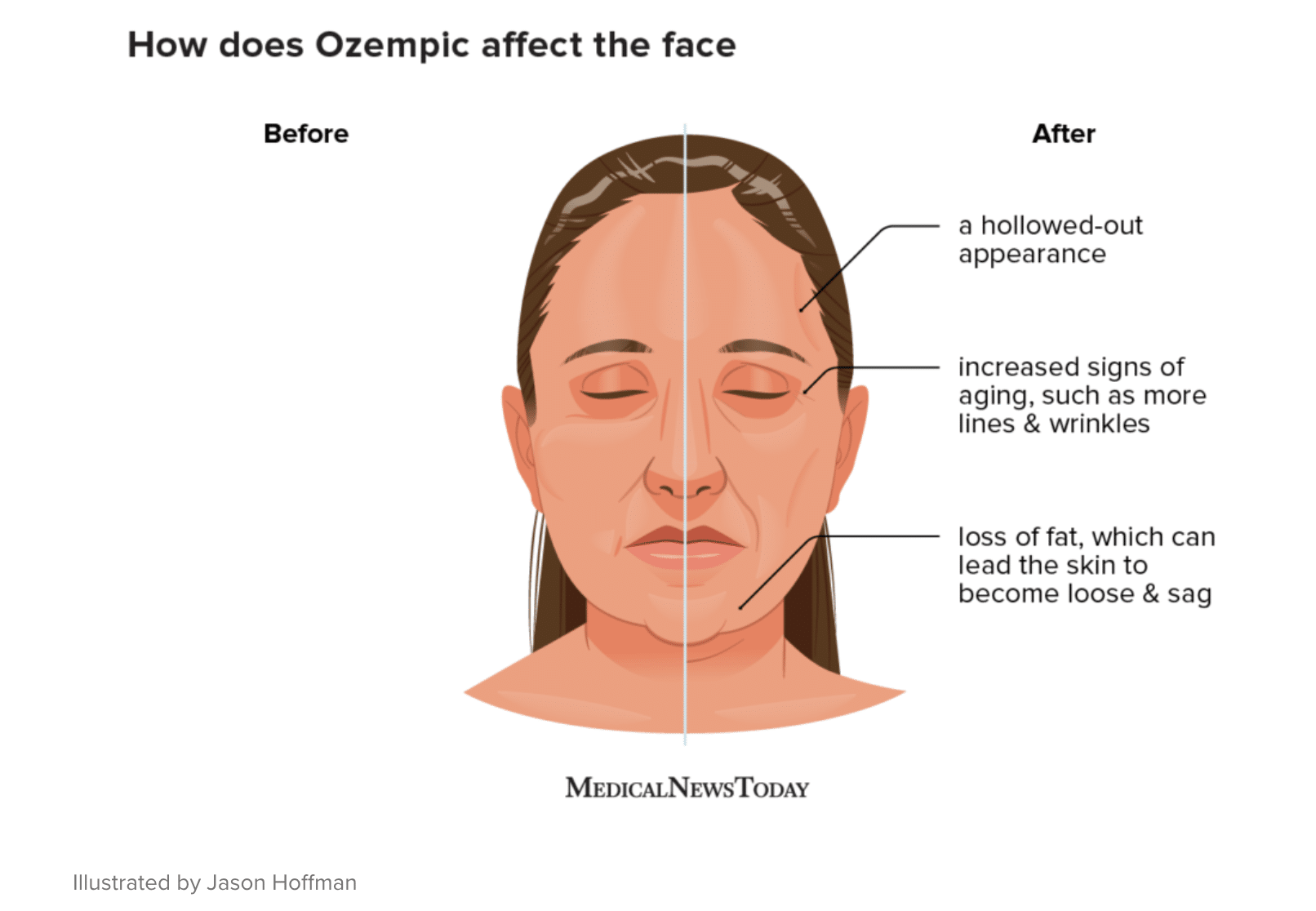 Treating Ozempic Face: Non-Surgical Options | SLK Clinic